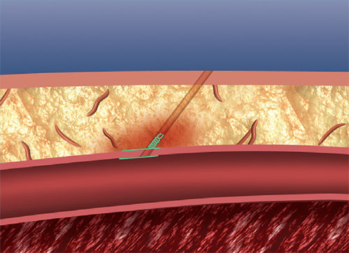 Perclose ProGlide Vascular Closure | Percutaneous Repair
