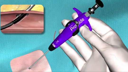 Perclose ProGlide | Single Device Deployment