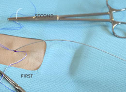 Perclose ProGlide | Multiple Device Deployment