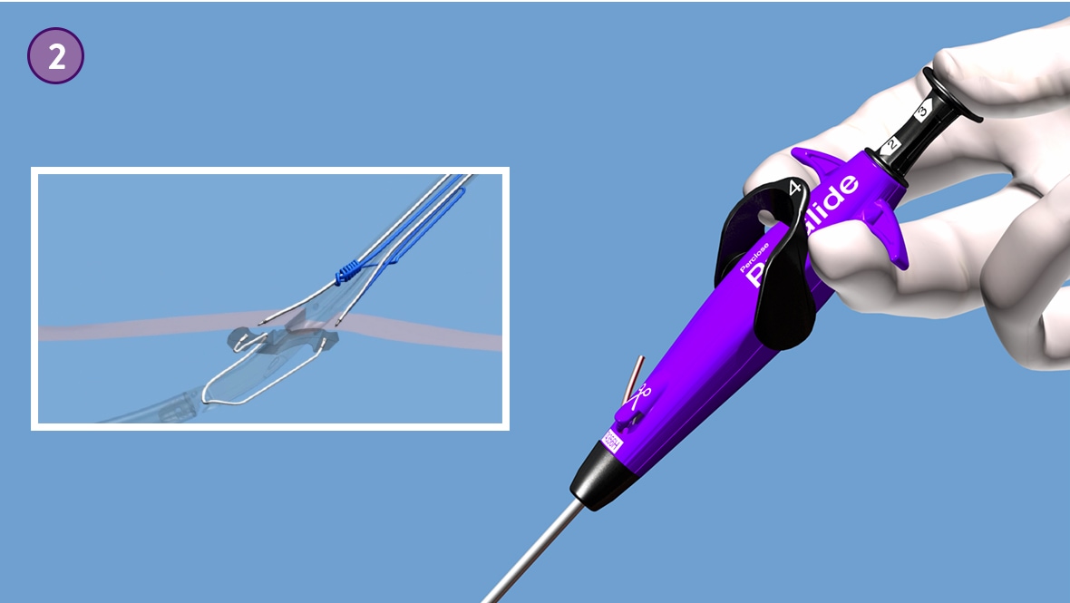 Perclose ProGlide Vascular Closure | Percutaneous Repair