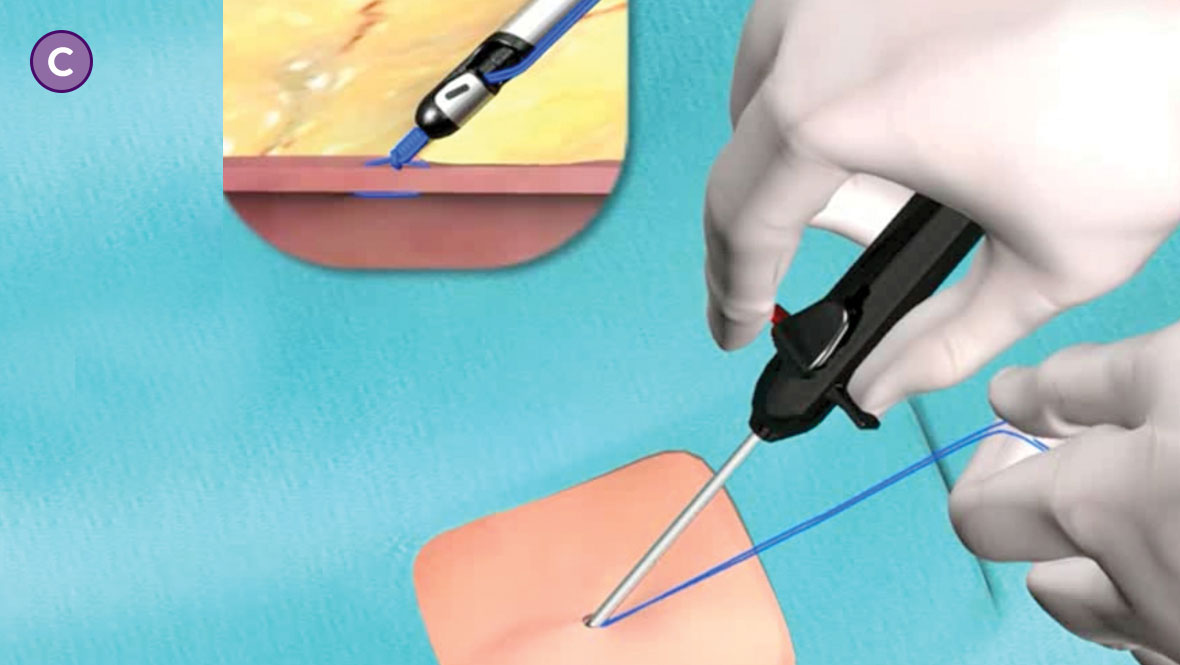 Perclose ProGlide Vascular Closure | Percutaneous Repair