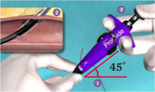 Perclose ProGlide Vascular Closure | Percutaneous Repair